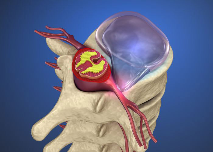 Discogram Procedure | Neck and Back Pain | DFW Arlington TX