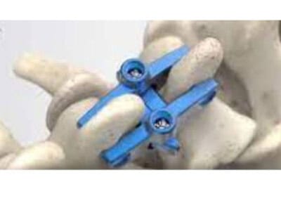 Inspan Spinal Stenosis and Fusion | Back Pain | Dallas, Fort Worth ...